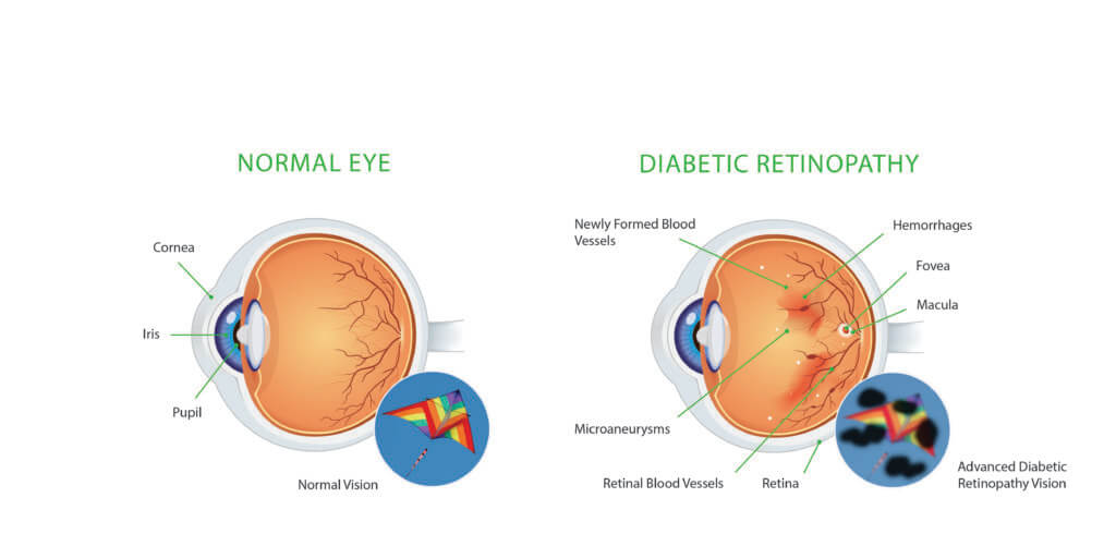 Diabetic Eye Exams • Burnt Hills Pediatrics and Internal Medicine